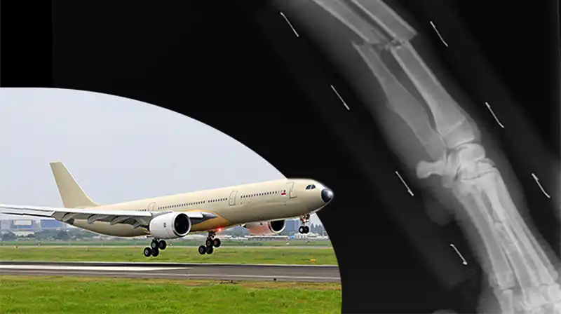 Can you fly with a broken leg or other bone?